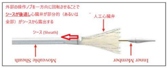Colibri Heart Valve v. Medtronic Corevalve（Fed. Cir. 2025-07） - Lexology